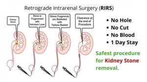 RIRS - Kidney stone treatment | Best Urology Hospital in Hyderabad